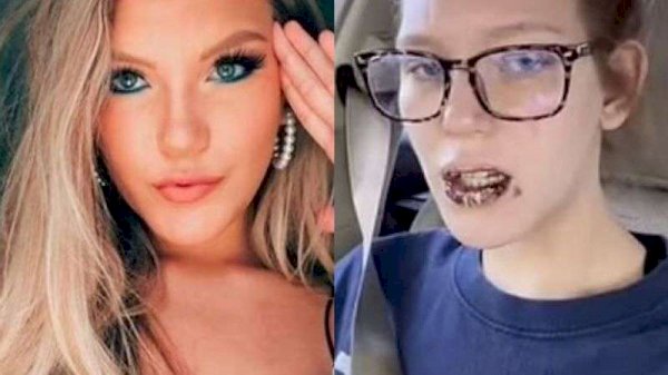 Le causa hongo en los labios la variante delta del covid | La Opción de ...